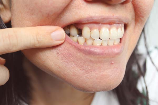 Replace Missing Teeth With Dental Bridges Dr Harneet Kaur DDS Paso Robles California